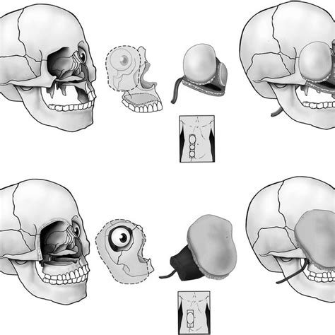 Pdf A Classification System And Algorithm For Reconstruction Of Maxillectomy And Midfacial Defects