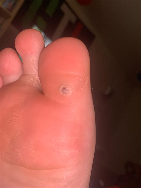 Black Spot On Big Toe Cause For Concern Rmelanoma