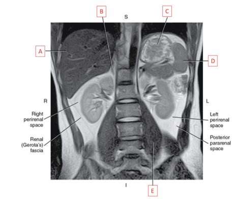 T2 Weighted Mri Coronal Abdomen Diagram Quizlet