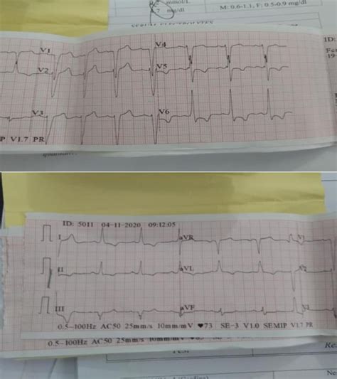 Figure 4 From Left Ventricular Noncompaction Cardiomyopathy Lvnc A Case Report Semantic Scholar