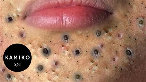 Pimple Popping Scenes Satisfy Viewers Blackhead Removal Acne