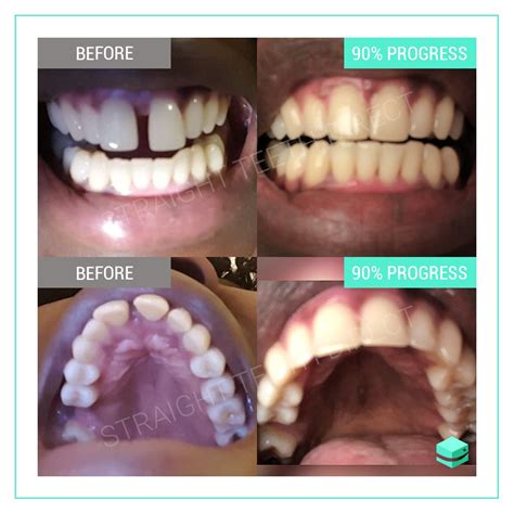 Retainers To Keep Teeth Straight After Braces Fixed Or Removable
