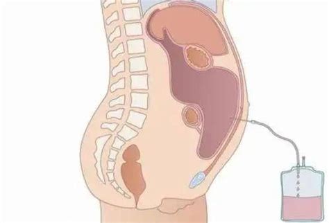 全省首家 出現胸腹膜轉移大量腹水怎麼辦胸腹水門診為您解決難題 每日頭條