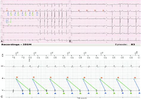 Surface Electrocardiogram And Iegm From Icd Programmer 25 Mms 10 Download Scientific Diagram