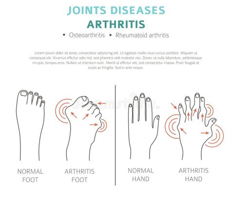 Joints Diseases Gout Symptoms Treatment Icon Set Stock Vector