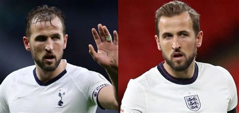 Harry Kanes Incredible Hair Transplant Transformation