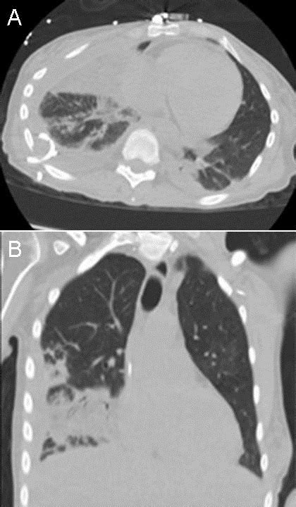 Southwest Journal Of Pulmonary Critical Care And Sleep Pulmonary