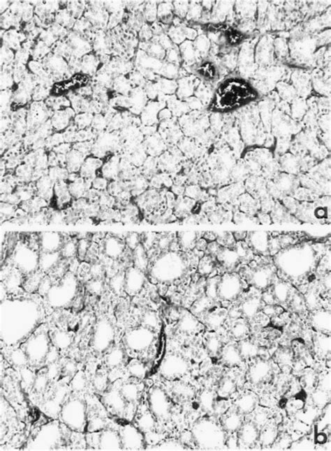 A Light Micrograph Illustrating Diffuse Hyperplasia Of The Thyroid