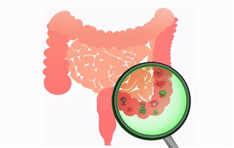 Treatment Of Acute Radiation Enteritis By Intragastric Administration Of Chitosan Oligosaccharide