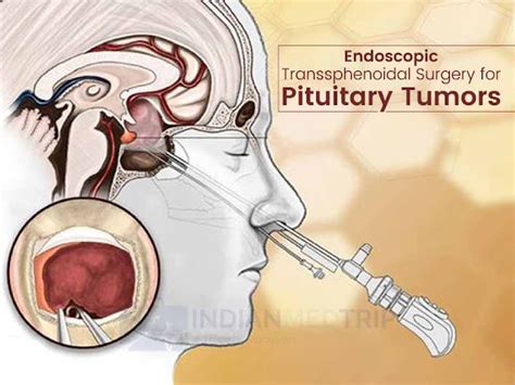 Affordable Endoscopic Transsphenoidal Surgery For Pituitary Tumors