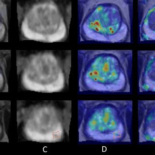 Results From The Worst Performing Patient Showing Three Histology