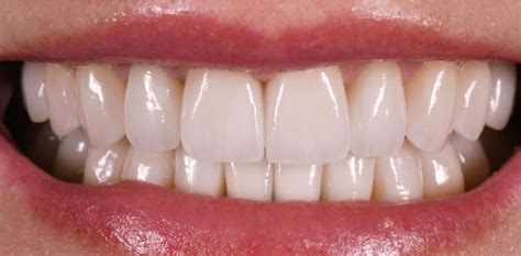 Veneers With Dr Plotnick