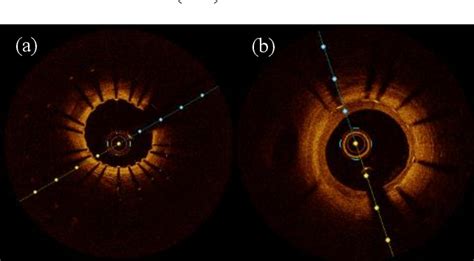 Figure 4 From A New Computer Aided Solution For The Automatic Detection Of Metal Stent Struts In