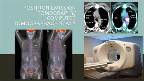 Positron Emission Tomography 2 YouTube
