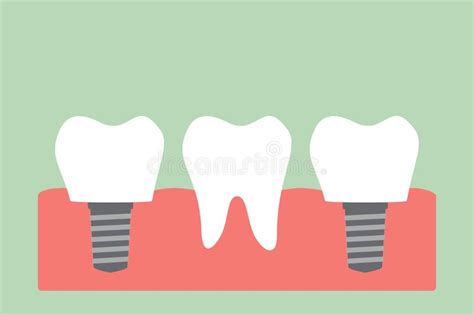 Dental Implant With Crown Stock Vector Illustration Of Simple 104855523