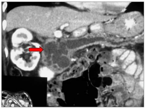 Intraductal Papillary Mucinous Neoplasm of the Pancreas: A Challenging ...