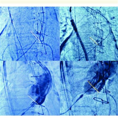 Per Procedural Images With Calcification Enhancement And Aortic Annulus Download Scientific