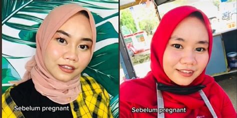 Potret Wanita Yang Hamil Alami Kondisi Aneh Wajah Bengkak Dan Keriput
