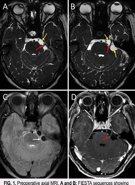 Figure From Trigeminal Neuralgia Secondary To Vascular Compression And Neurocysticercosis