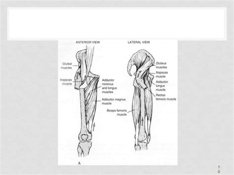 Midshaft Femur Fracture Ppt