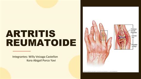 Artritis Reumatoide Kora Porco UDocz