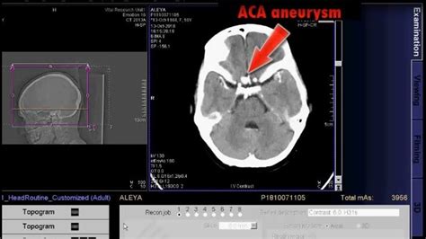 Ct Scan Brain Anuresym