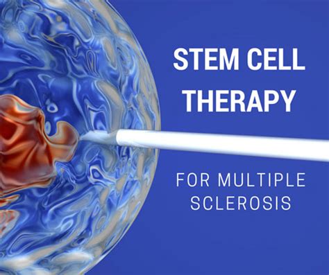 Stem Cell Therapy For Multiple Sclerosis Cellgen