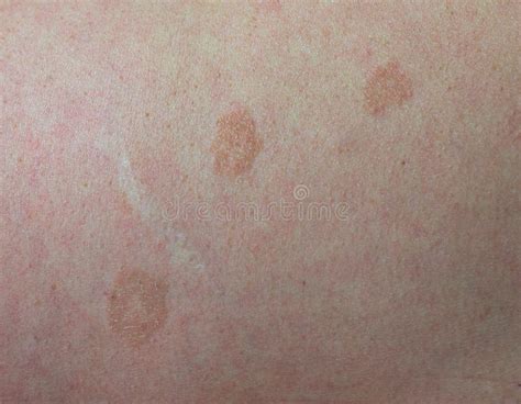 Tinea Versicolor Itch At Seth Rudall Blog