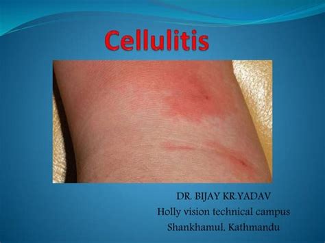Cellulitis Pptx