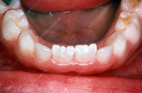 Permanent Teeth Removed Over Retained Incisors Stock Image C039