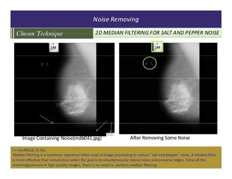 Microcalcification Identification In Digital Mammogram For Early Dete…