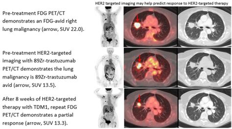 How To Code Emphysema And Copd