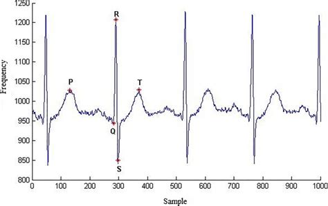 Ecg Beat Signal Labeled By P Q R S And T Download Scientific Diagram