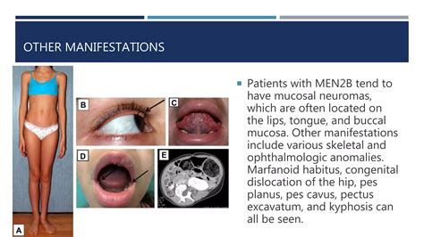 Multiple Endocrine Neoplasia Type 2 Pptx Thyroid Disorders Endocrine And Metabolic Diseases