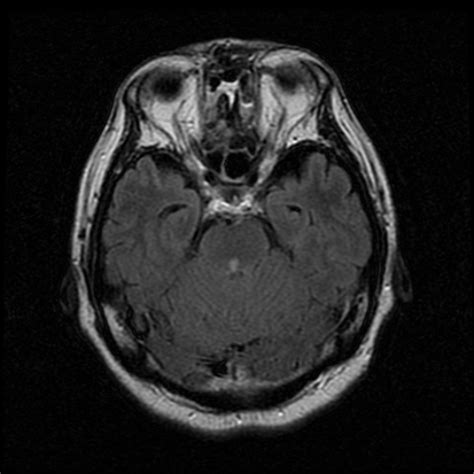 Internuclear Ophthalmoplegia Mri