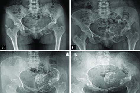 Radiographs Taken After One A Two B Three C And Six D Download Scientific Diagram