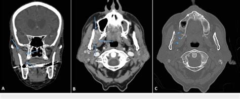 Masticatory Space Metastasis A B Ct Scan Of The Neck Showing A Mass