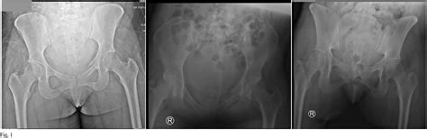 Figure 1 From Pathologic Pubic Symphysis Diastasis In Pregnant Pelvic