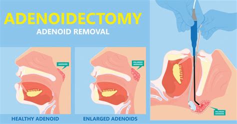 Adenoidectomy