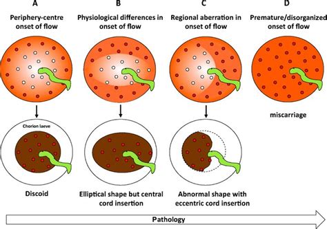 Discoid Placenta