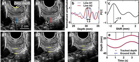 Quantification Of Cervical Elasticity During Pregnancy Based On Transvaginal Ultrasound Imaging