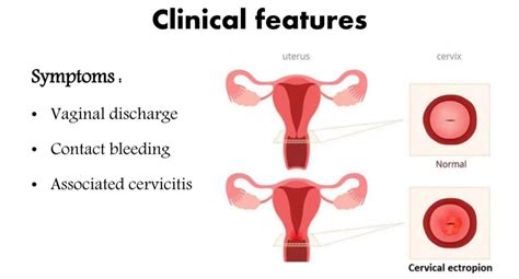 Dne212 Cervical Ectropion Cervical Erosion Nurses Online Discussion