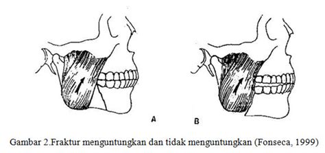 Fraktur Mandibula 3  Dokter Bedah Mulut
