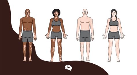 Understand Vitiligo The Autoimmune Skin Condition Explained