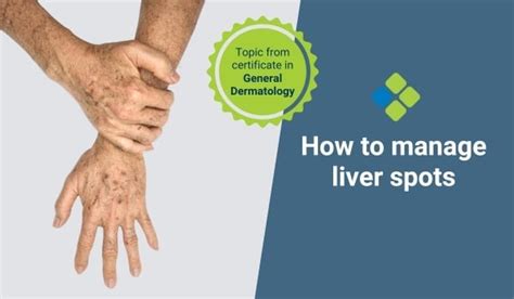 How To Manage Liver Spots