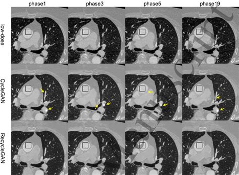 Low Dose Phases Of The Test Patient Denoised By Different Methods Top Download Scientific