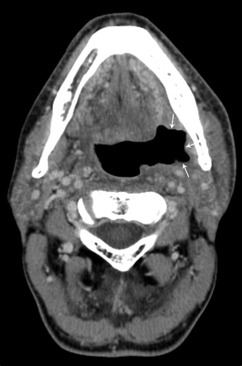 Benign Ulceration As A Manifestation Of Soft Tissue Radiation Necrosis