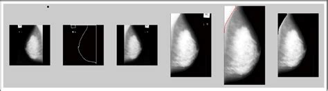 Table From Deep Learning Algorithm For Breast Masses Classification In Mammograms Semantic