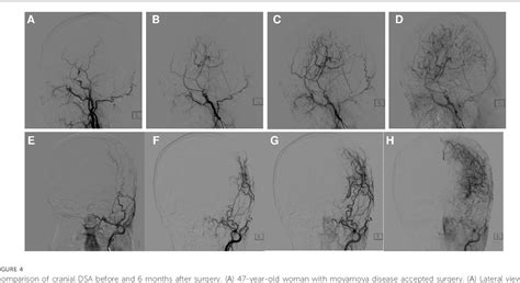 efficacy of modified edas combined with a superficial temporal fascia