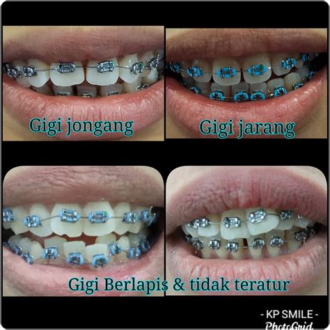 Gigi Jongang Pakai Braces Elisabethmcybarron